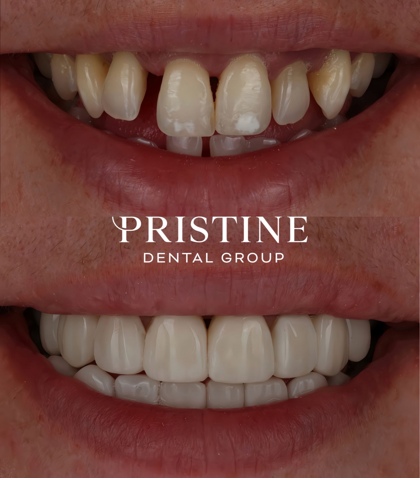 Straighten Teeth - Pristine Dental Group